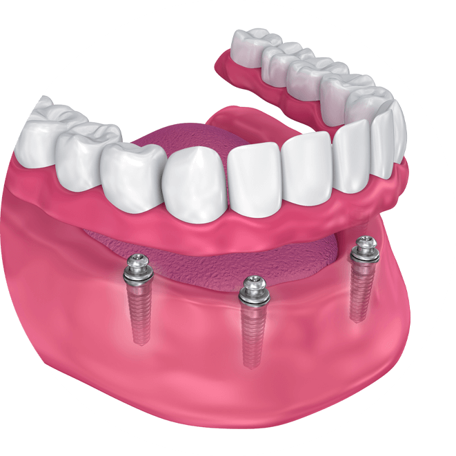 Fixed Teeth vs Removable | Papillion Nebraska | PREMIER ORAL SURGERY