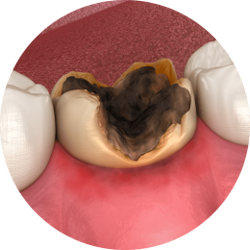 Tooth Extraction | Papillion Nebraska | Extract Teeth